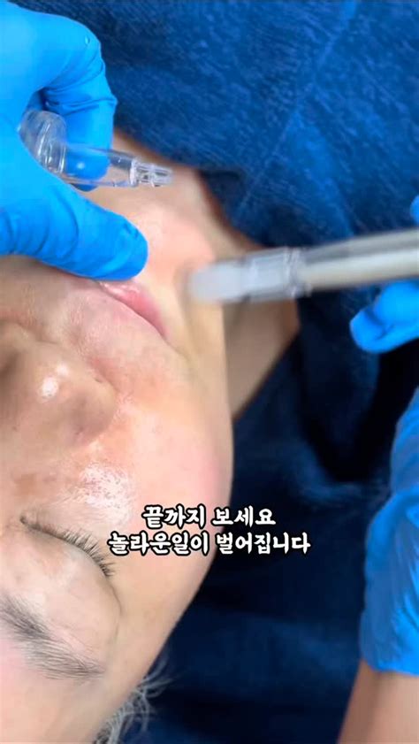 일산피부 일산슈퍼젝션 │ 요미뷰티 피부구원연구소 │ Skin 52 ️ 피부 환생시간 10분 ️ 10분만에 피부가 환생한다면🥹 피부과와는 다른 에스테틱만의 특별한