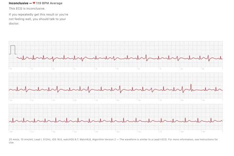 Pvcs Most Frequent During Weight Lifting R Pvcs