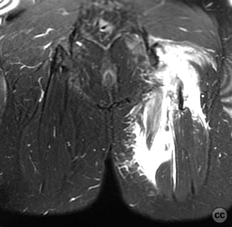 Proximal Hamstring Tendon Avulsion