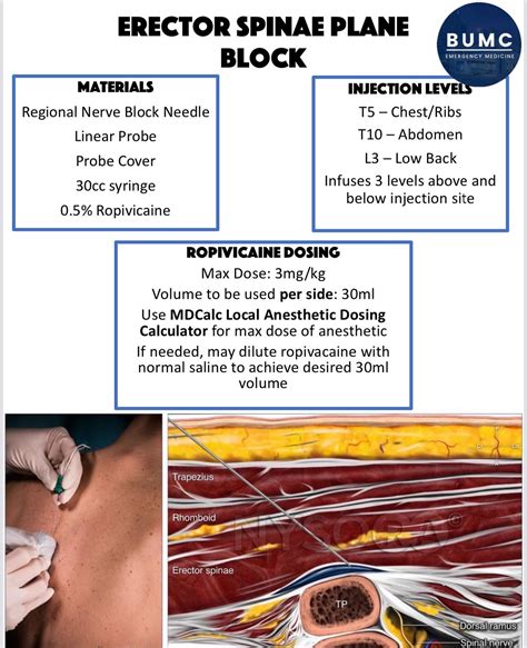Erector Spinae Plane Block 1 Bumcem