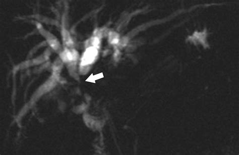 Mimics Of Cholangiocarcinoma Spectrum Of Disease Radiographics