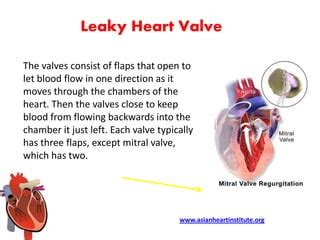 Asian Heart Institute Leaky Heart Valve Symptoms Pptx