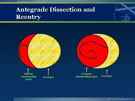 Subintimal Tracking And Reentry For Cto Star Method
