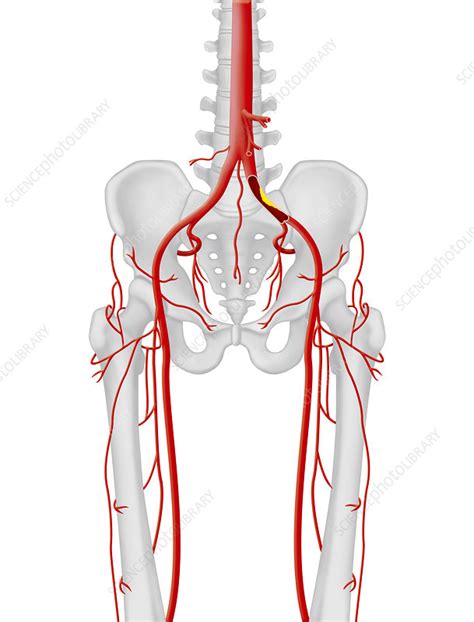 Arterial Stenosis Stock Image C029 7636 Science Photo Library
