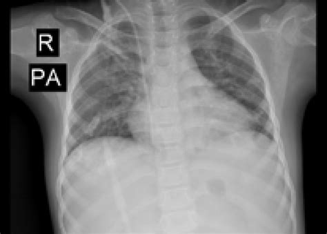 A Mild Nonspecific Reticular Pattern In Chest X Ray Download