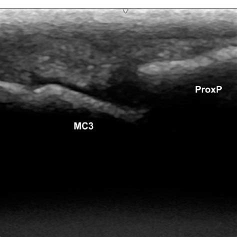 Longitudinal Mid Sagittal Dorsal Image Of The Metacarpophalangeal