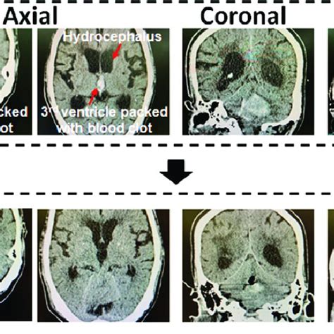 Pre And Postoperative Radiographic Findings In Case 2 Ct Scan Before Download Scientific