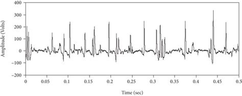 Typical Myopathy And Als Emg Signals Download Scientific Diagram