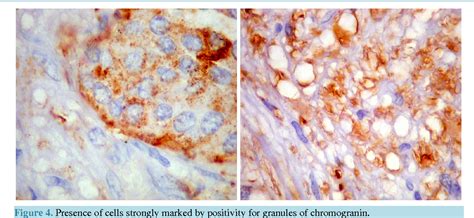 Set Of Anterior Jugulo Omohyoid Lymph Nodes Semantic Scholar