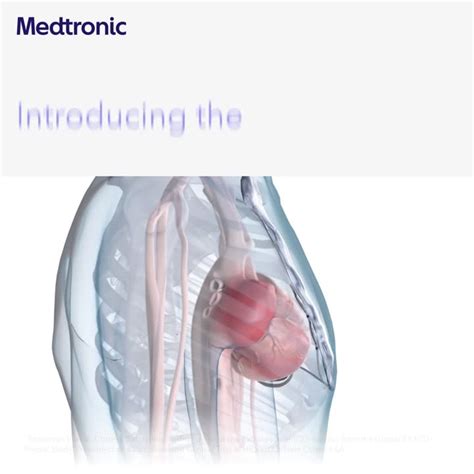 Medtronic Cardiac And Vascular On Linkedin Aurora Ev Icd™ System