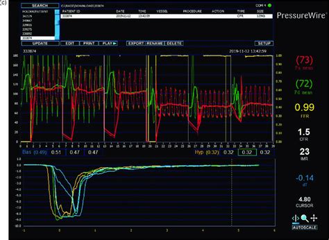 Concept Of Imr A Theoretical Basis For The Measurement Of Imr