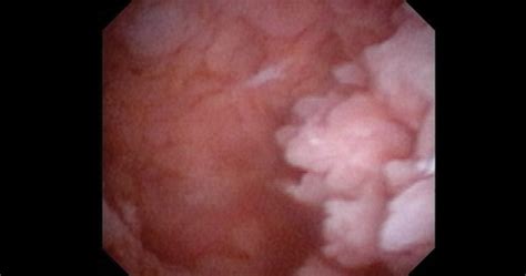 The Role Of Hysteroscopy In Diagnosing Endometrial Cancer Mdedge