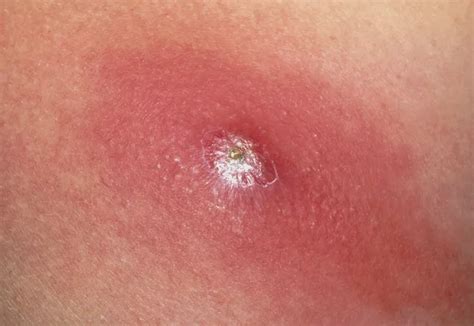 Boils Causes Picture On Skin And Treatment