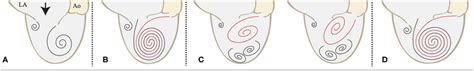 Schematics Of Lv Vortex Interaction In Diastole A The Intramitral