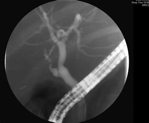 Two Months Post Cholecystectomy ERCP Showing Complete Resolution Of Download Scientific Diagram