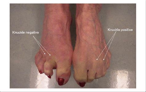 A Depiction Of Positive And Negative Knuckle Test Results Download Scientific Diagram