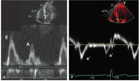 Evaluation Of Left Ventricular Diastolic Function Thoracic Key