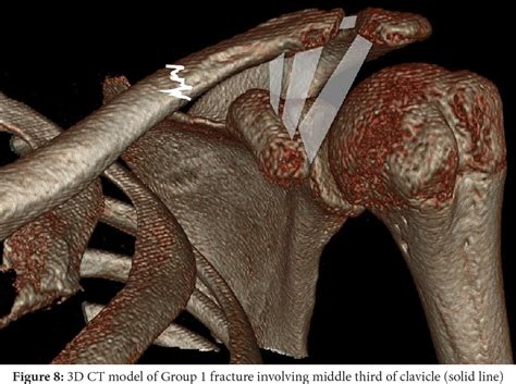 Figure 8 From Clavicle Fractures Allman And Neer Classification Semantic Scholar