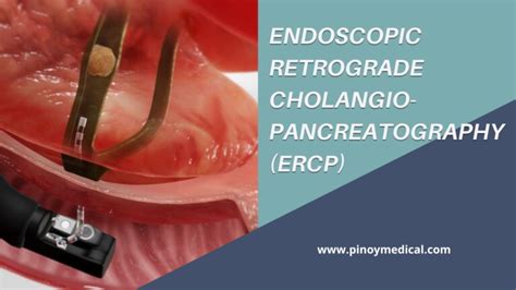 Ercp Price In The Philippines 2025 — Pinoymedical