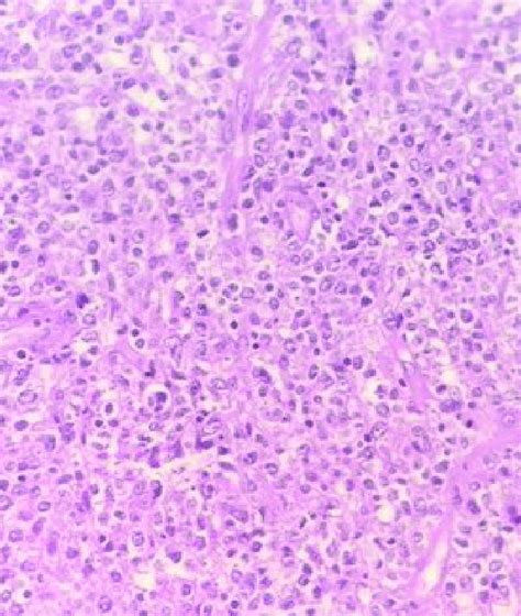 Primary Diffuse Large B Cell Lymphoma Of Cns Proliferation Of Tumor Download Scientific