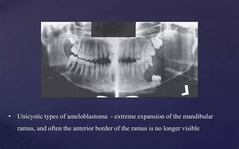 Radiographic Features Of Tumors Of Jaws Pptx