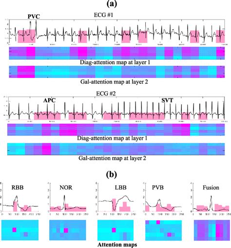 figure 5 from refined self attention transformer model for ecg based