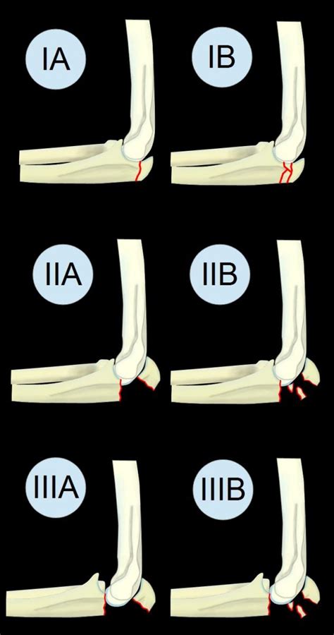 Fracture Of Olecranon Mayo Classification Classifications Online Calculators And Tables In