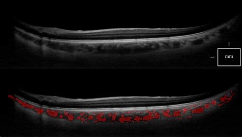 A Cross Sectional 1060 Nm Oct Tomogram Of A Healthy Eye Using A Single