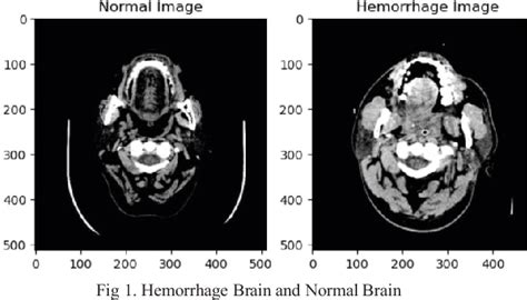 Figure 1 From Intracranial Hemorrhage Detection Using Deep Learning And Optimization Techniques