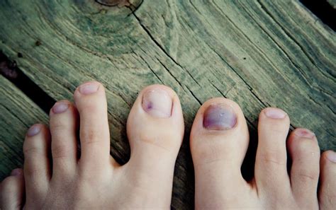 Fungal Toe Blister