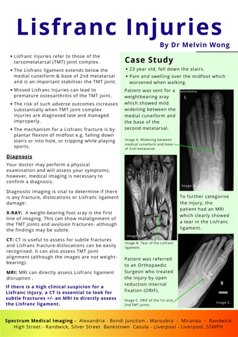 Foot Injuries Is That A Lisfranc Injury Gp Voice