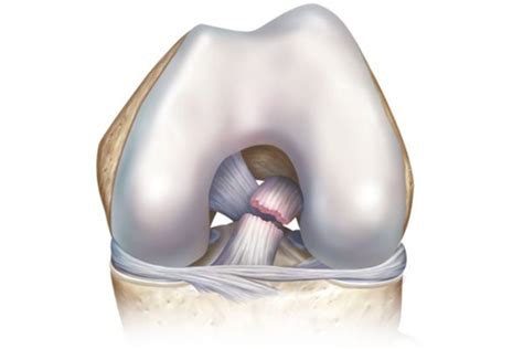ACL Injury Anterior Cruciate Ligament Injury Param Hospital Orthopedic Hospital In Surat