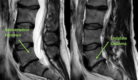 Basivertebral Nerve Wikimsk Basivertebral Nerve Wikimsk
