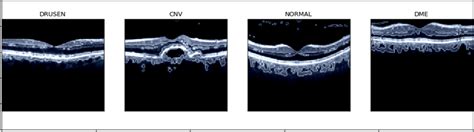 Final Processed Images After Retinal Structure Edge And Layer