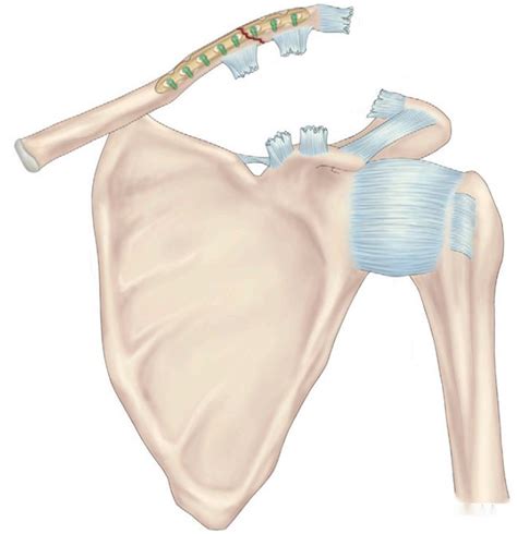 News How To Stabilize A Midshaft Clavicle Fracture Combined With