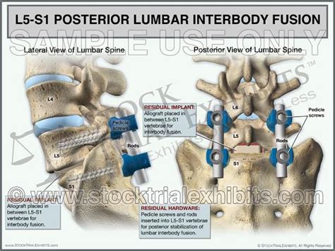 L5 S1 Posterior Lumbar Interbody Fusion Plif Lumbar Medical Illustration Fusion