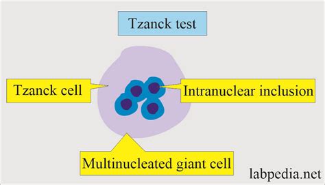 Tzanck Cells In Hsv