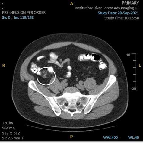 Ct Transverse Image Showing Enlargement Of The Appendix And Cluster