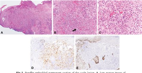 Figure 1 From Cutaneous Angiosarcoma Of The Scalp In A Pediatric