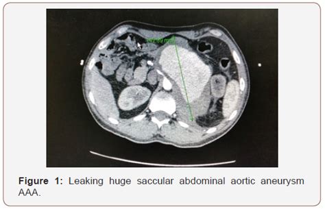 Challenging Saccular Aorto Iliac Aneurysms In Behcets Disease Iris Publishers