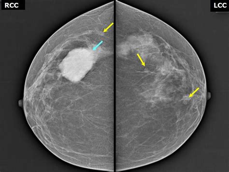 breast cyst mammogram