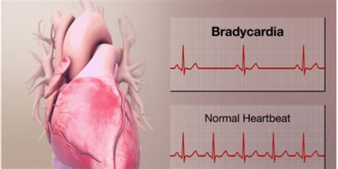 Bradycardia Hope For Hearts
