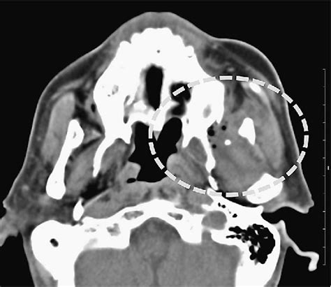 Figure 4 From A Case Of Infratemporal Fossa Abscess With Signs Of Chronic Maxillary