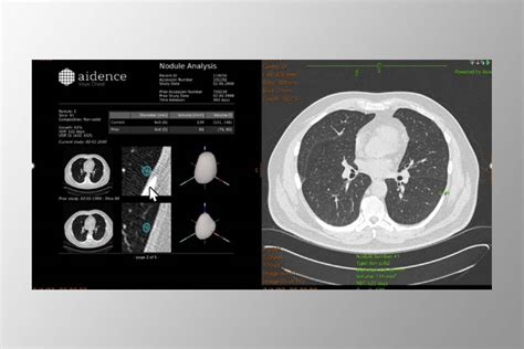 TMC Secure Even Higher Radiology Quality With Now Implemented AI