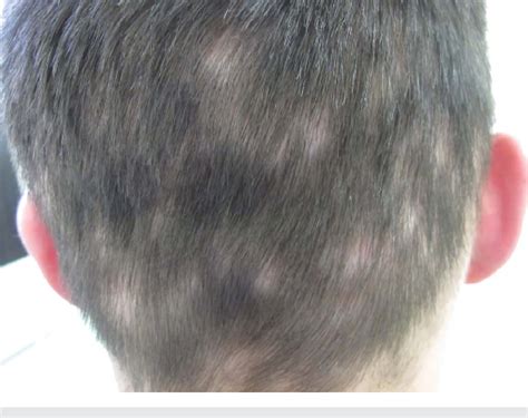 Figure From Differential Diagnostics Of Syphilitic Alopecia And Alopecia Areata The Clinical