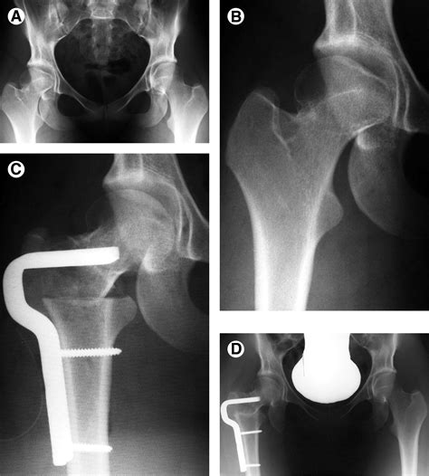 Proximal Femoral Osteotomy Current Indications And Techniques