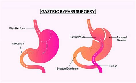 Gastric Bypass Vs Gastric Sleeve What S The Difference ALO Bariatrics