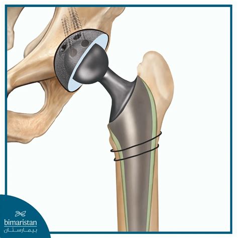Hip Replacement Surgery In Turkey Bimaristan