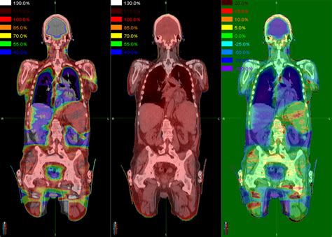 Example Comparison Of The Dose Distributions For A Targeted Marrow Download Scientific Diagram