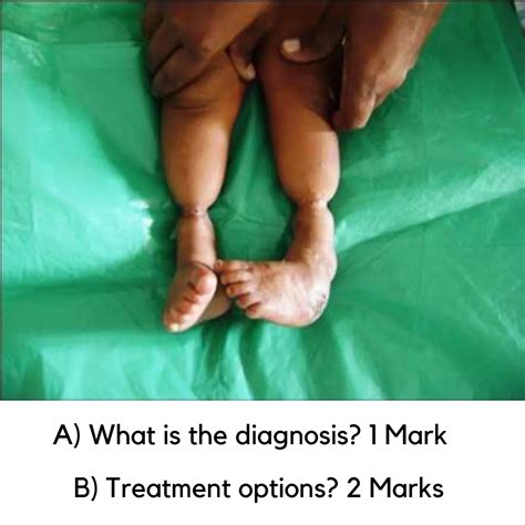 Orthopaedic Tutorials Constriction Ring Syndrome Also Known As